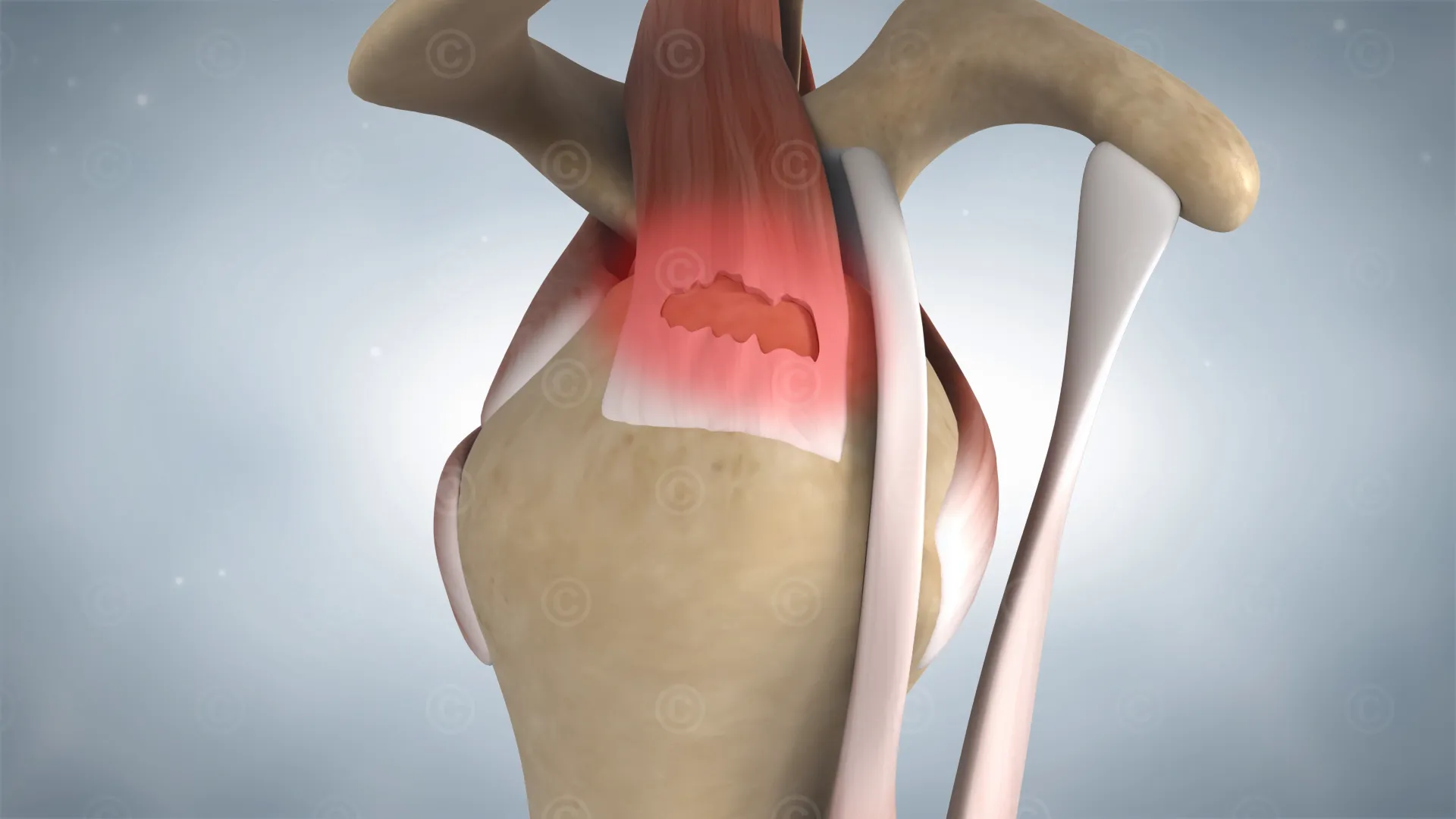 Animation rupture rotator cuff - MedicalGraphics