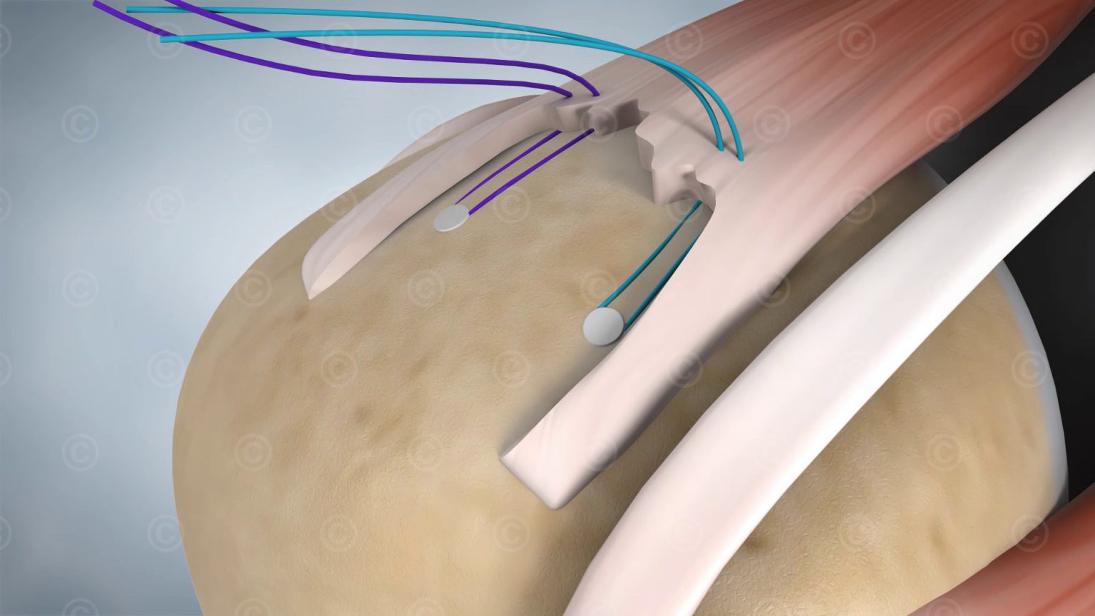 Animation rupture rotator cuff - MedicalGraphics