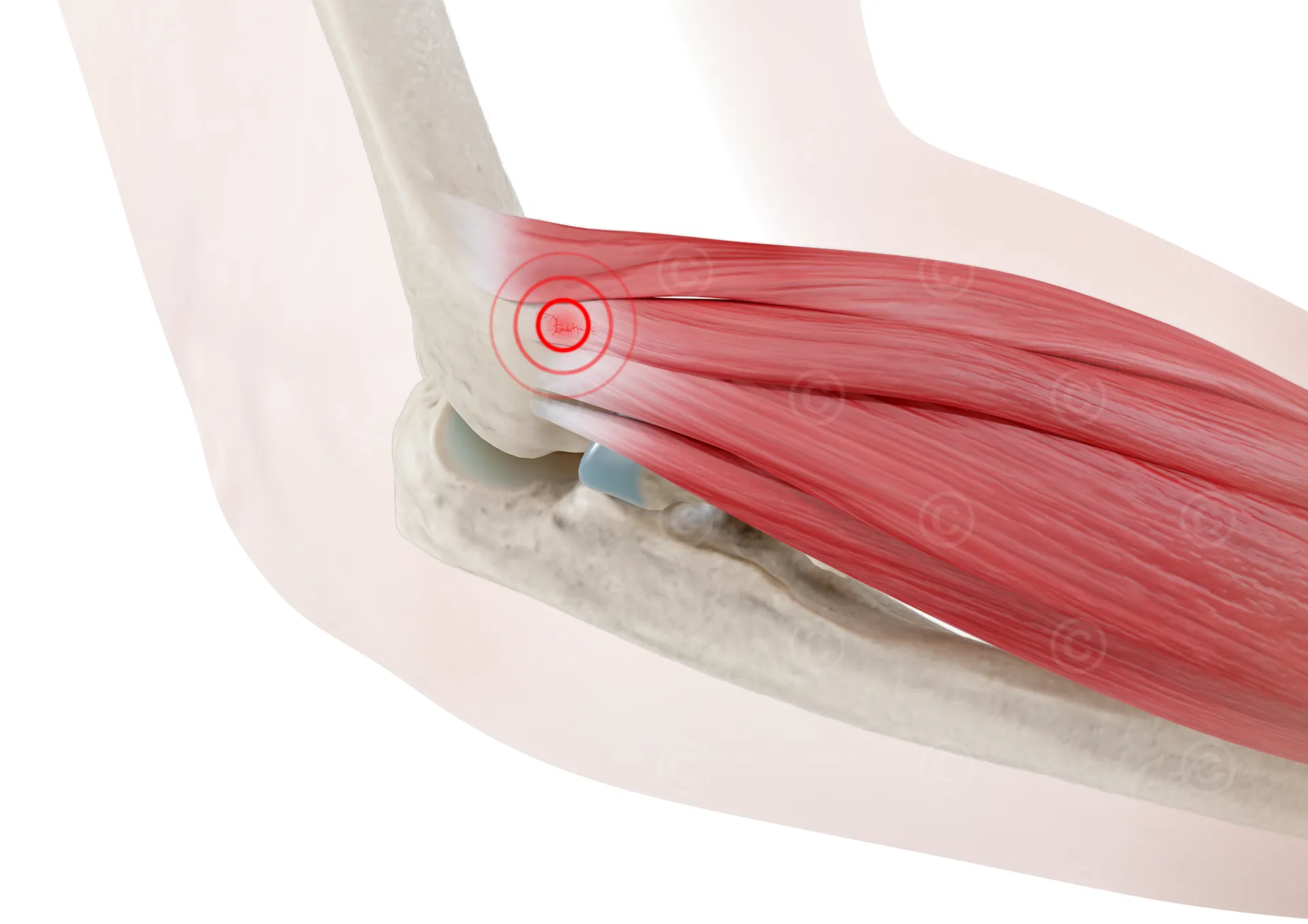 Illustrationen Tennisarm - MedicalGraphics