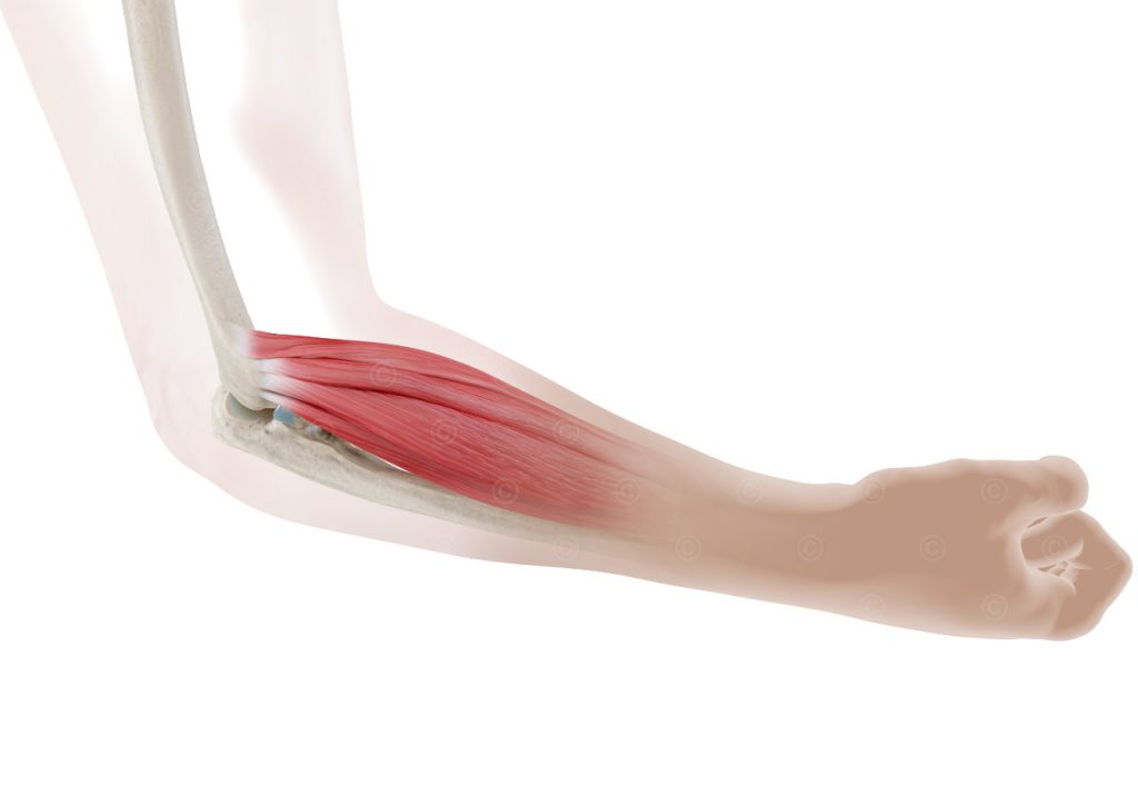 Illustrationen Tennisarm - MedicalGraphics