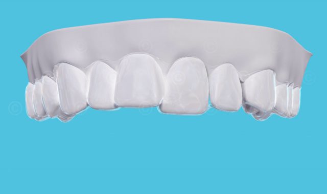 Animations Aligner therapy - MedicalGraphics