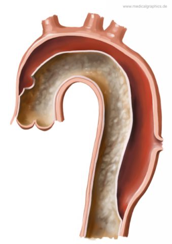 Free Illustration Aortic dissection - rupture
