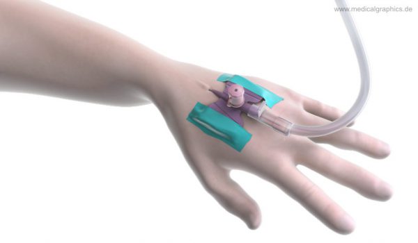 Free illustration Intravenous access hand
