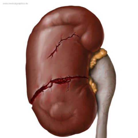 Free illustration Kidney rupture