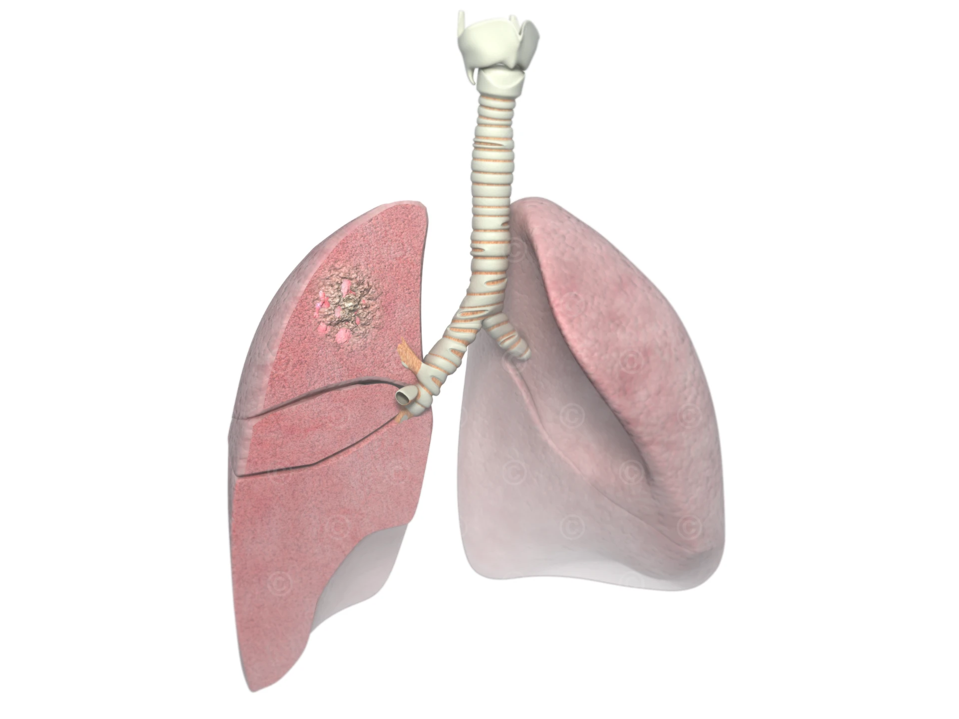 Illustration Lungenkarzinom - MedicalGraphics