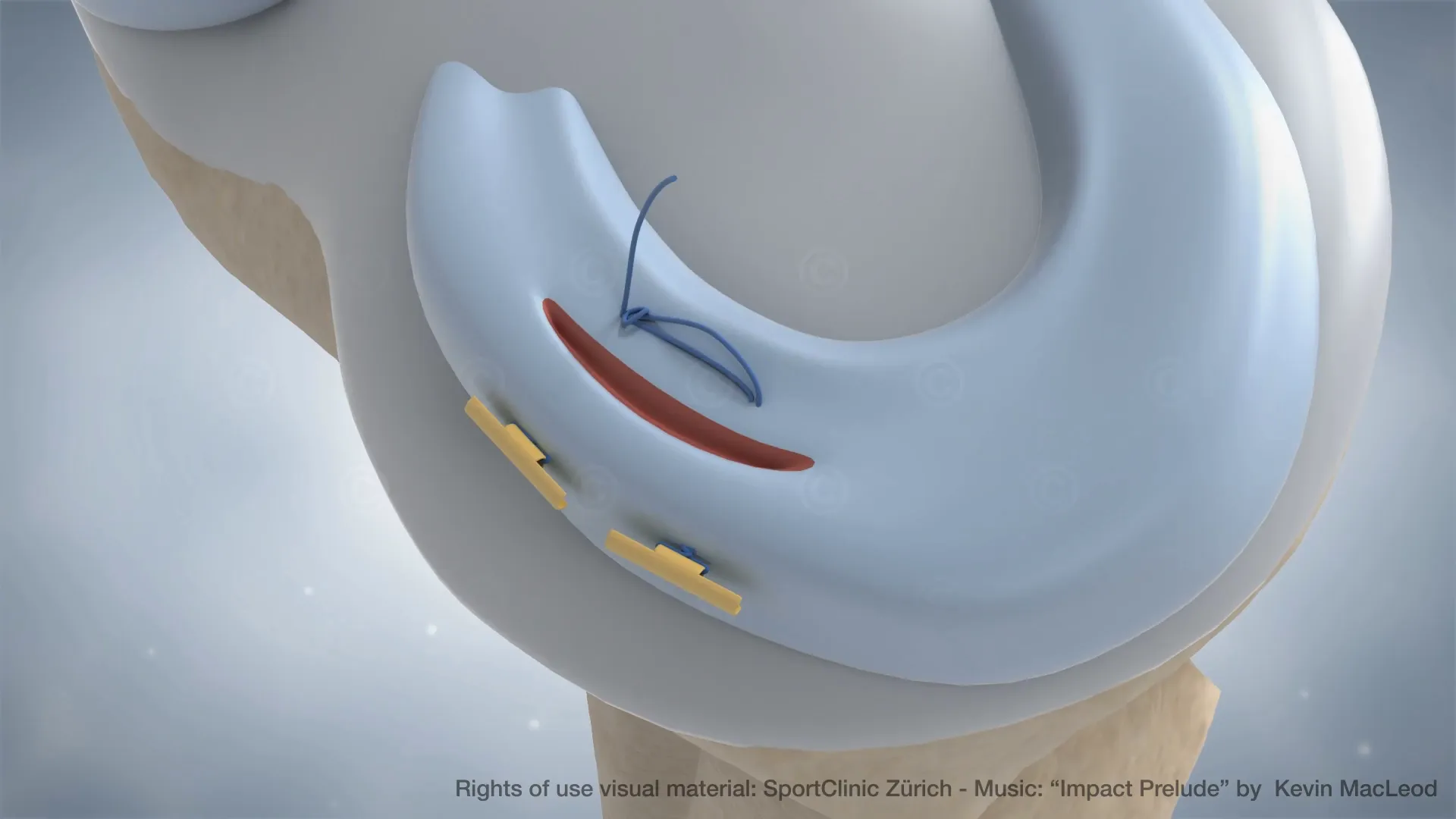 Animation Meniscus injuries - MedicalGraphics