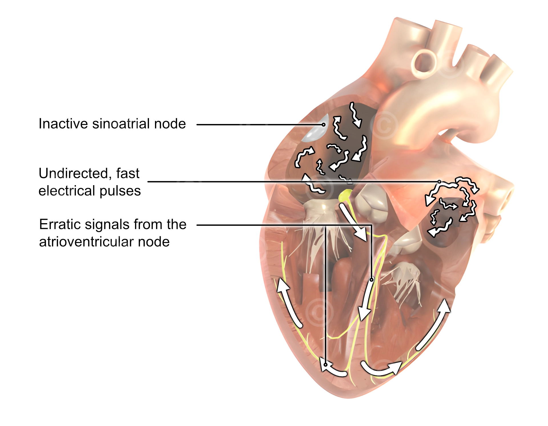 Fast Atrial Fibrillation