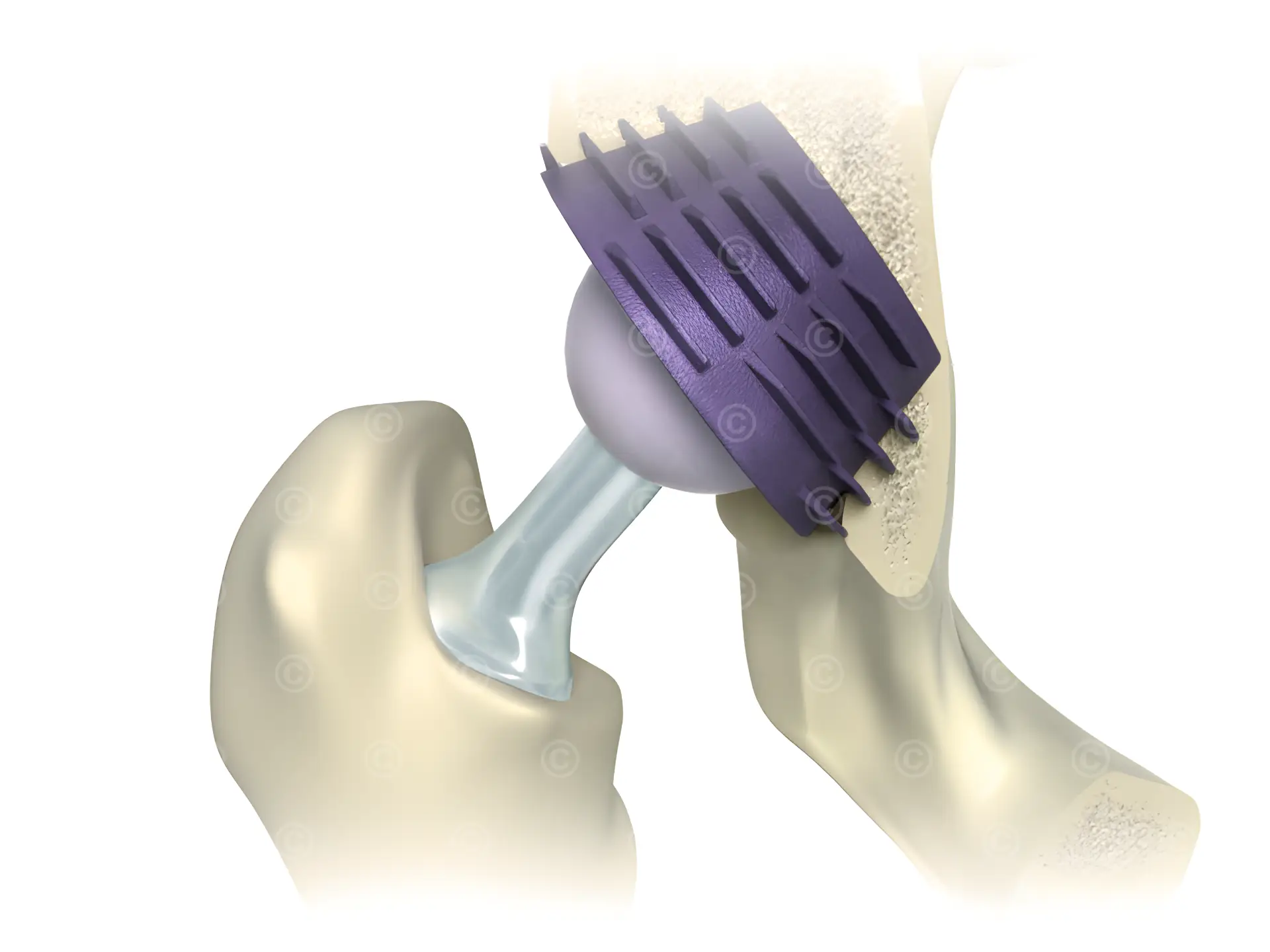 Illustration hip replacement - MedicalGraphics