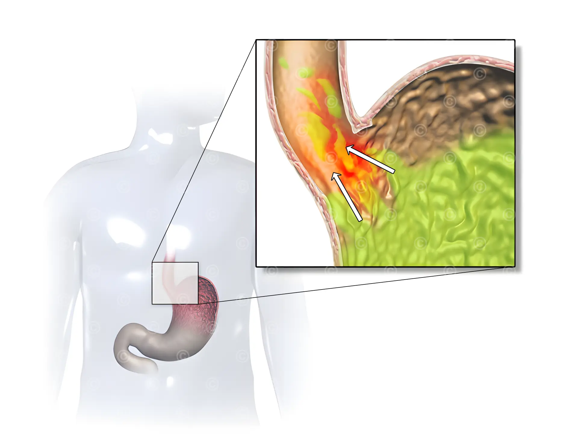 Illustration gastric reflux - MedicalGraphics