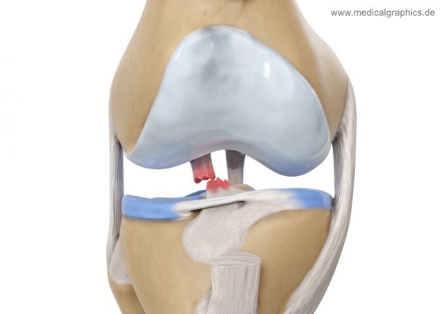 Anterior cruciate ligament tear - front - MedicalGraphics