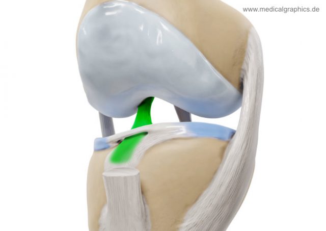 Anterior cruciate ligament without patella - MedicalGraphics