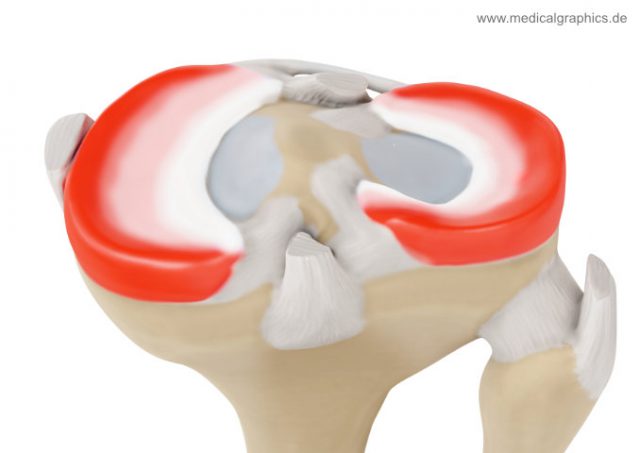 Zones blood flow meniscus - rear - MedicalGraphics