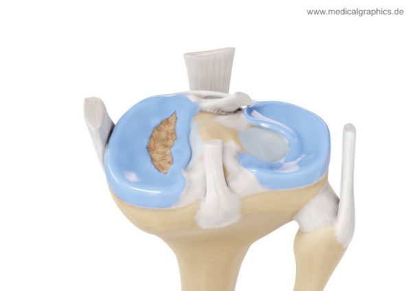 Bucket handle tear meniscus - rear - MedicalGraphics