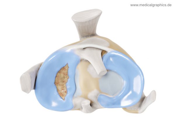 Bucket handle tear meniscus - top - MedicalGraphics