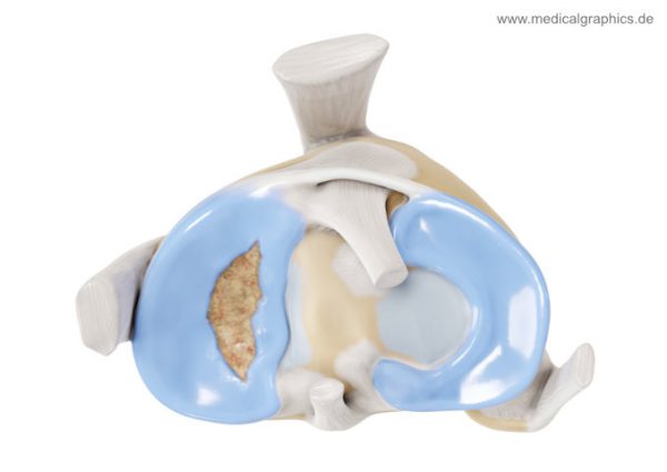 Korbhenkelriss Meniskus - Aufsicht - MedicalGraphics