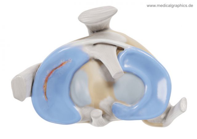 Längsriss Meniskus - oben - MedicalGraphics