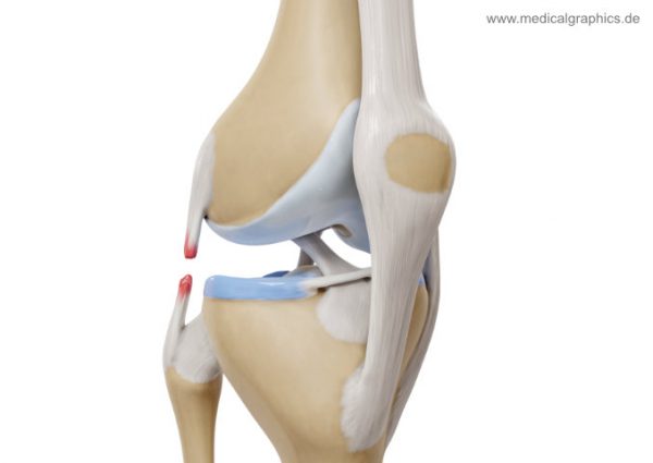 Lateral collateral ligament tear - front lateral - MedicalGraphics