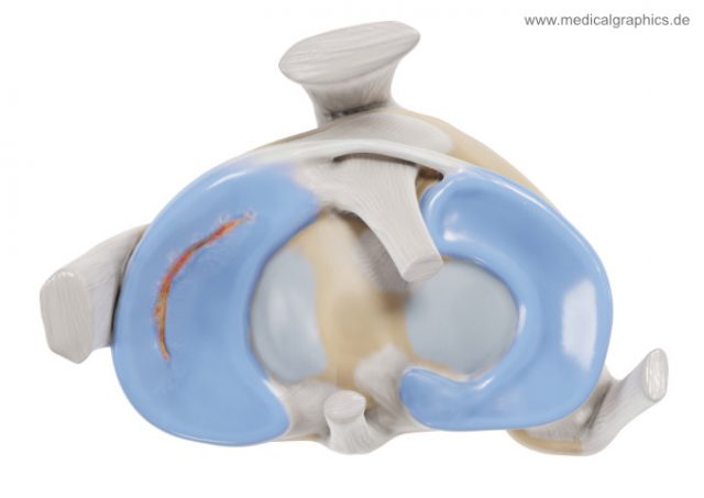 Longitudinal tear meniscus - top - MedicalGraphics