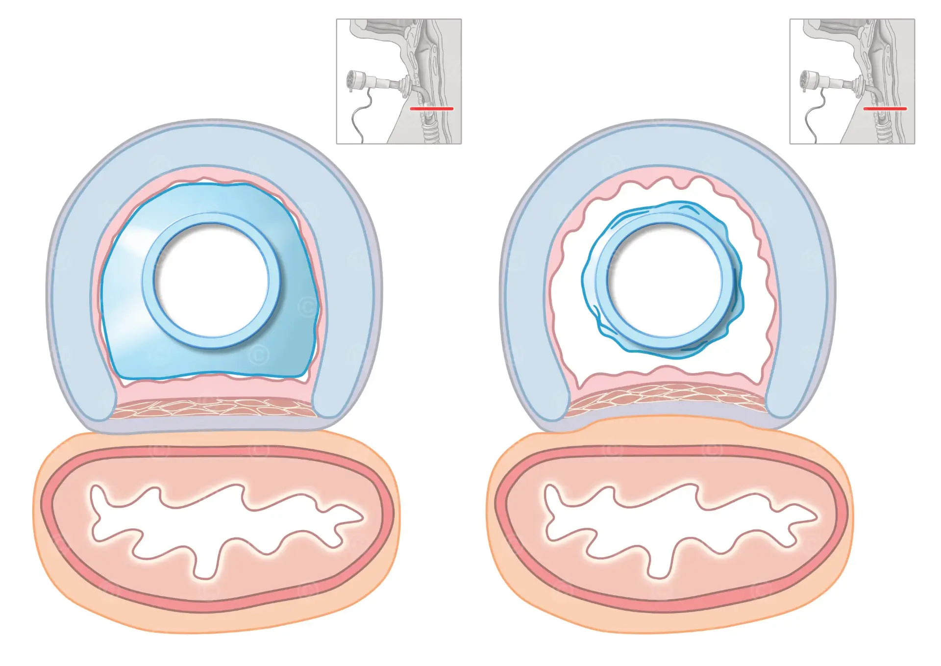 Illustration Trachealkanülen im Querschnitt - MedicalGraphics