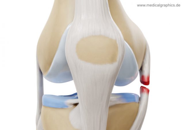 Innenbandriss Knie Symptome – Innenbandriss Knie Behandlung – WQWZK