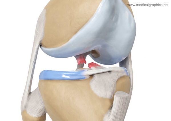 Riss vorderes Kreuzband - lateral vorne - MedicalGraphics