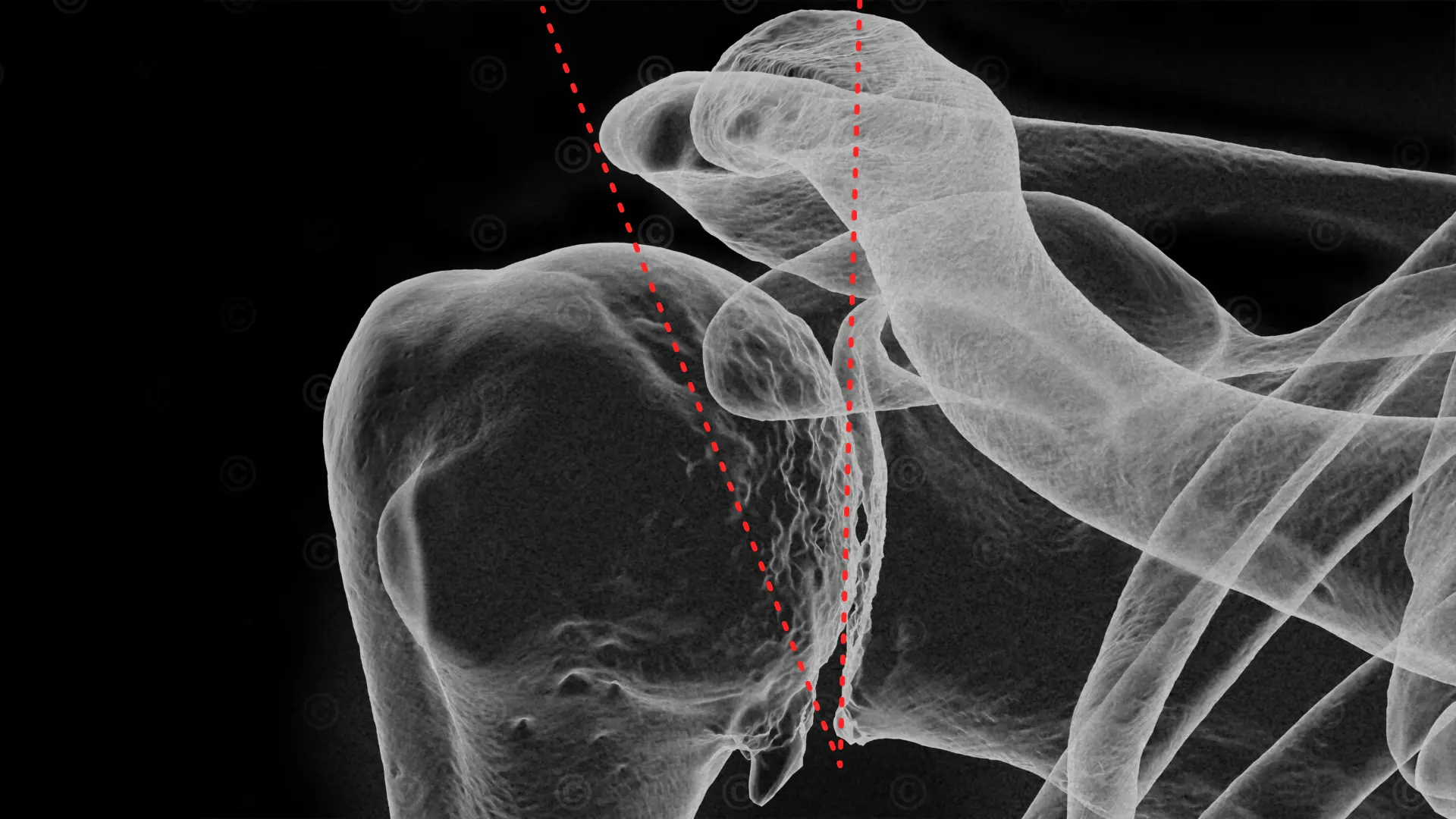 Illustrationen Critical Shoulder Angle - MedicalGraphics