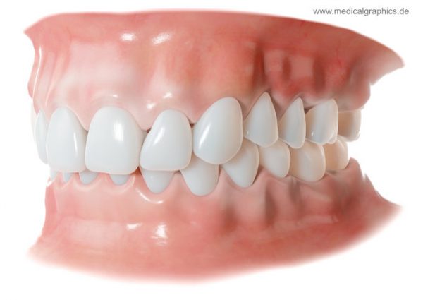 Deep bite - malocclusion - MedicalGraphics