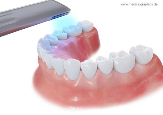 Intraoral scanner - MedicalGraphics