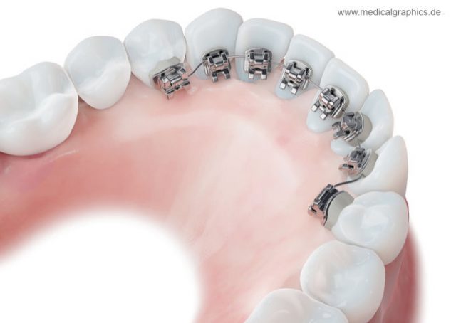 Brackets lingual - front - MedicalGraphics