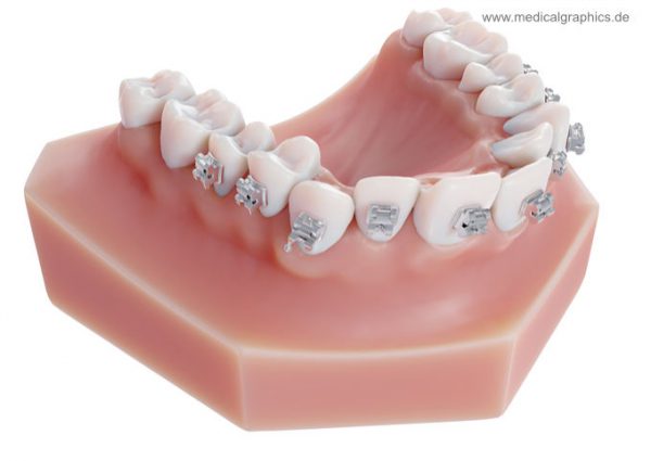 Brackets on resin model - MedicalGraphics