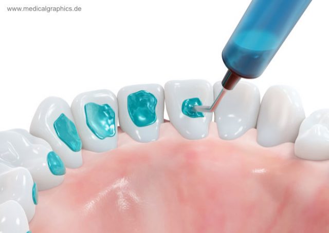 Etching teeth for braces - MedicalGraphics