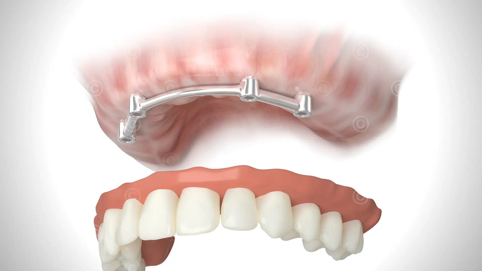 3D animation bar retained overdentures- video - MedicalGraphics