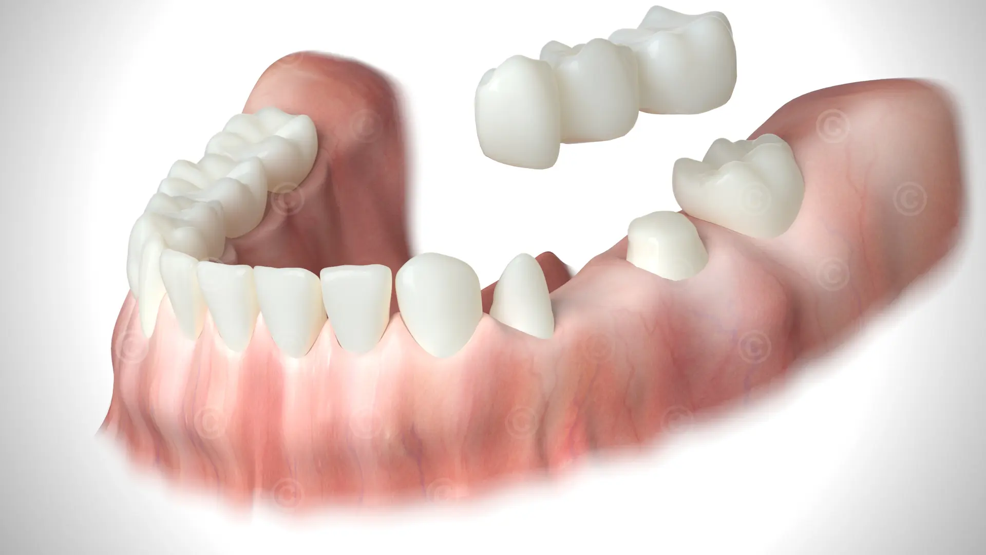 3D animation dental bridge- Video - MedicalGraphics