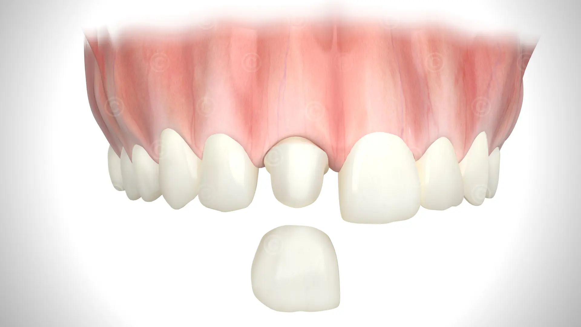 3D animation dental crown - Video - MedicalGraphics