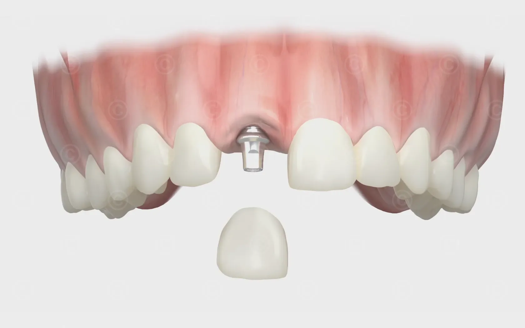 3D animation dental implant - Video - MedicalGraphics