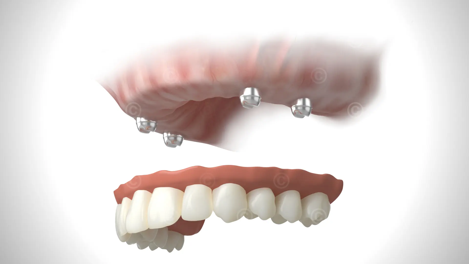 3D animation telescopic prosthesis - video - MedicalGraphics